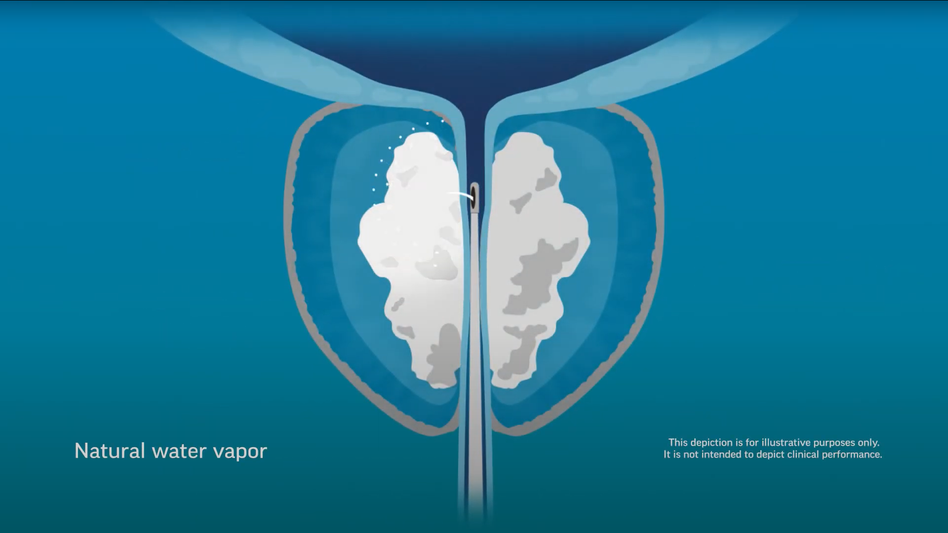 Trajtimi i prostates me metodën Rezum Water Vapor - Medical Center